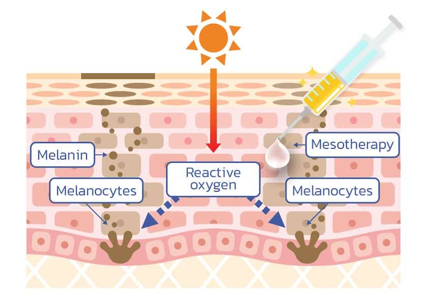 การฉีดเมโสฝ้ากระ (Meso Melasma) ช่วยลดฝ้า ลดเลือนจุดด่างดำได้อย่างไร