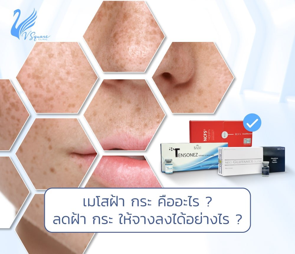การฉีดเมโสฝ้ากระ (Meso Melasma) ช่วยลดฝ้า ลดเลือนจุดด่างดำได้อย่างไร