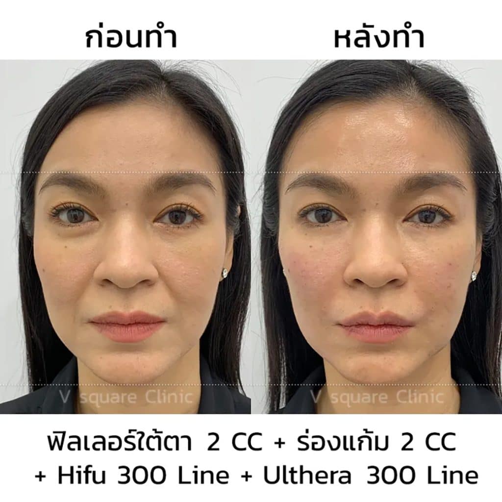 Ultraformer III กับ Ulthera ต่างกันอย่างไร? เหมาะกับใคร เลือกแบบไหนดี?