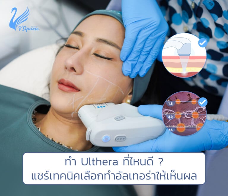 รวม Top คลินิก ทำ Ulthera ที่ไหนดี ? อัพเดทล่าสุด 2024 เลือกคลินิกทำอัลเทอร่าเห็นผล ไม่โดนหลอก