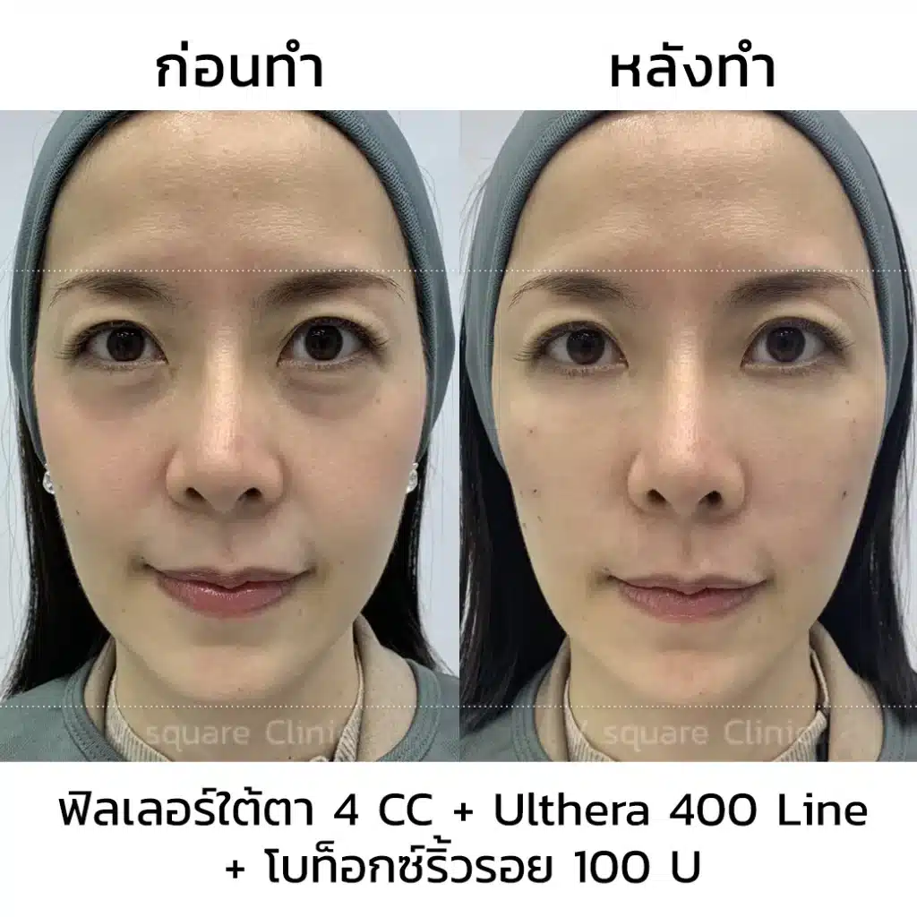 [แนะนำ] Thermage กับ Ulthera ต่างกันอย่างไร เทียบชัด ๆ ข้อดี-ข้อเสีย ...