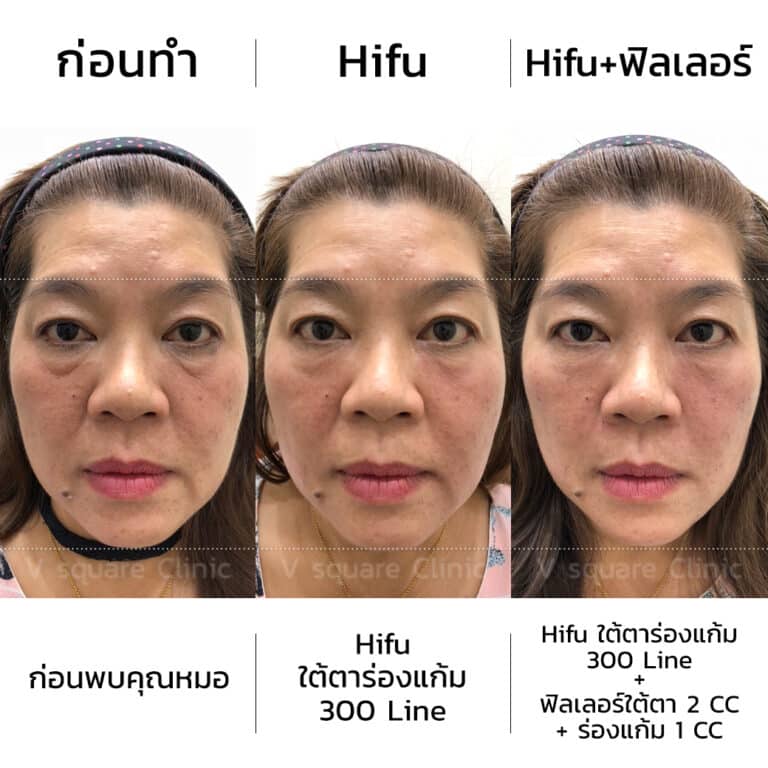 Ultraformer MPT คืออะไร ? ต่างกับ Hifu ไหม ช่วยอะไรบ้าง อัปเดต 2025