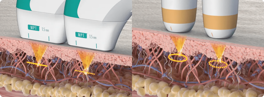 Ultraformer MPT คืออะไร ? ต่างกับ Hifu ไหม ช่วยอะไรบ้าง อัปเดต 2025