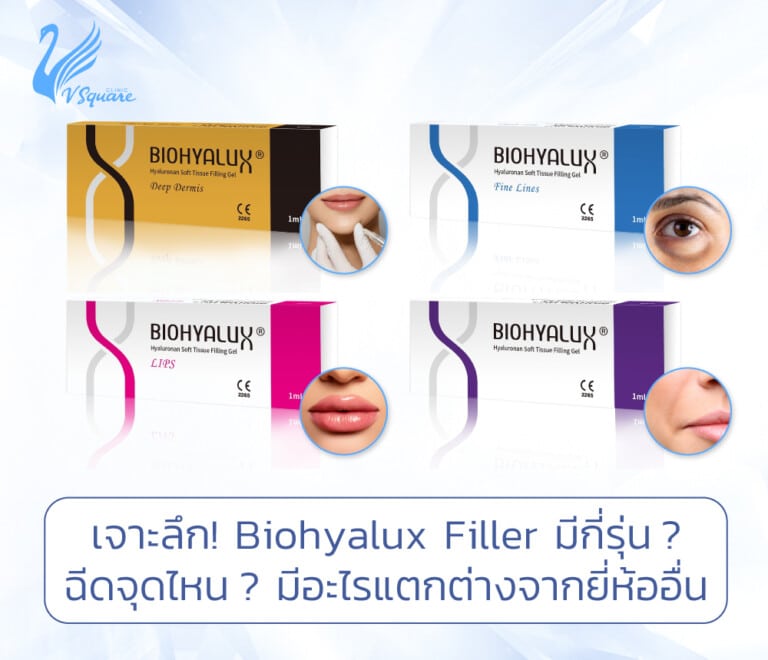 Biohyalux Filler สัญชาติจีน ฉีดแล้วไม่บวม เทคโนโลยีพิเศษ เห็นผลชัดเจน