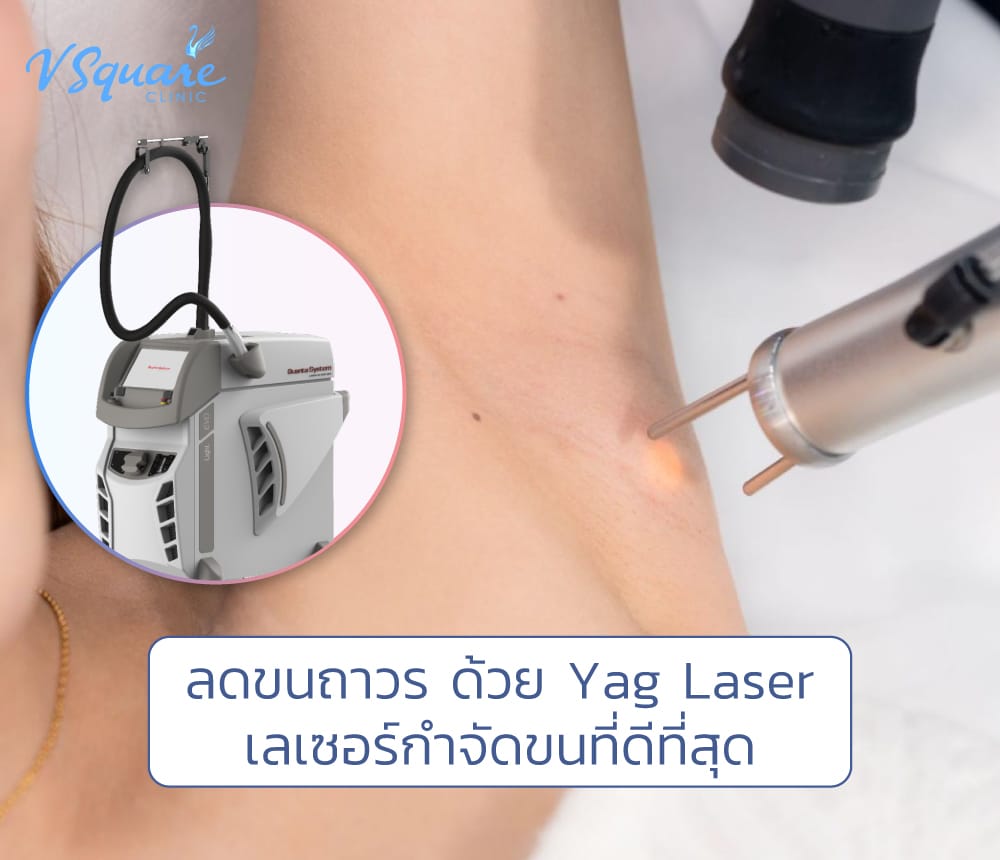 YAG Laser เลเซอร์กำจัดขนที่ดีที่สุดจริงหรือ ขนหายถาวร คุ้มค่าไหม