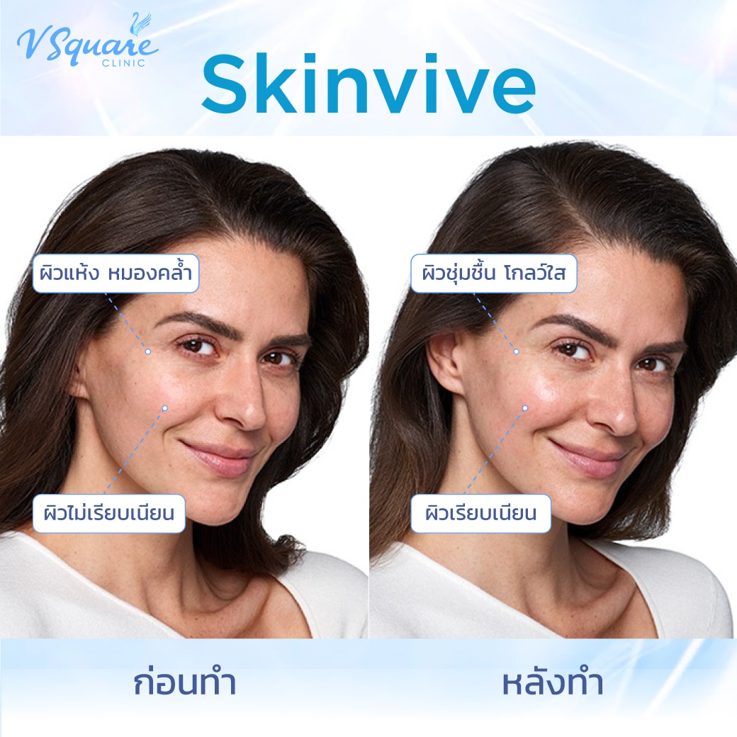 Skinvive ฟิลเลอร์งานผิวใหม่ล่าสุด ฉีดผิวฉ่ำ ลดหน้ามัน ปรับผิวใส มีงานวิจัยรับรอง