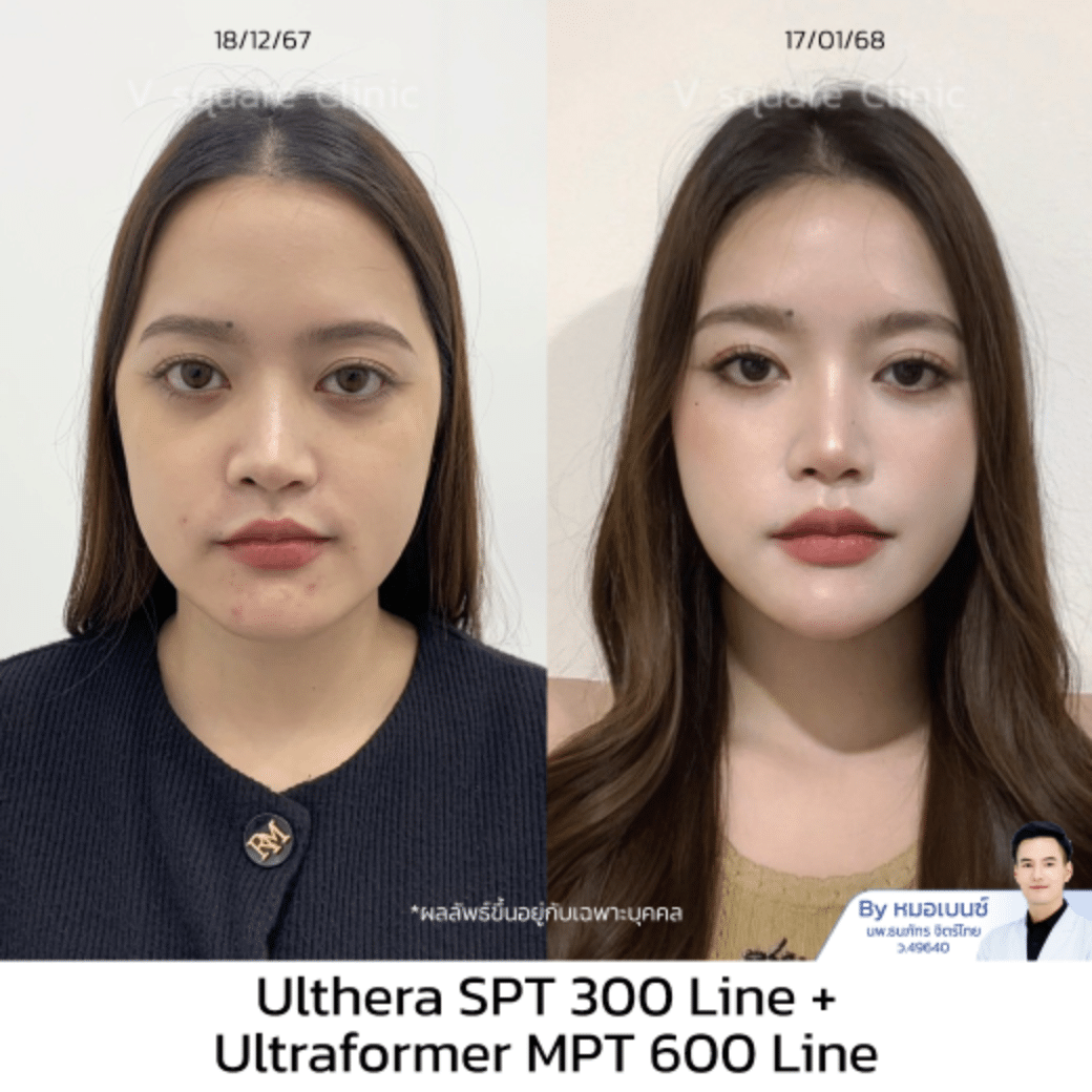 Ulthera (อัลเทอร่า) ราคาเท่าไหร่ ? เปิดราคาแยกเฉพาะจุด ตำแหน่ง shot/line