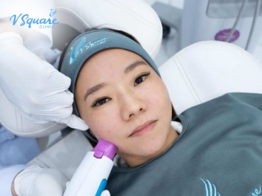 Thermage ควรทำกี่ Shot แต่ละตำแหน่งใช้กี่ช็อตเห็นผล