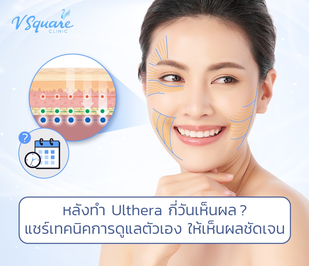 Ulthera กี่วันเห็นผล ? ใช้เวลานานแค่ไหน กว่าจะเห็นผลเต็มที่