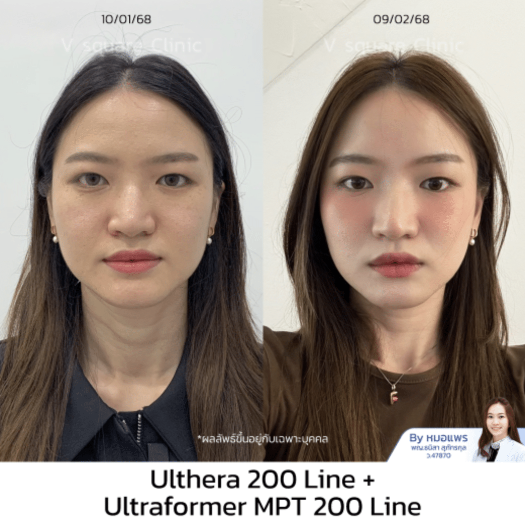 Ulthera (อัลเทอร่า) ราคาเท่าไหร่ ? เปิดราคาแยกเฉพาะจุด ตำแหน่ง shot/line