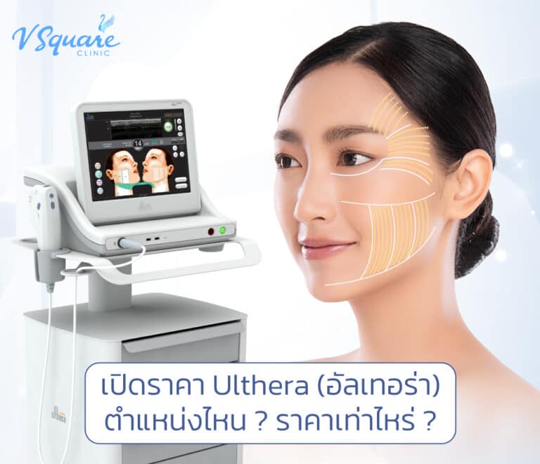 Ulthera (อัลเทอร่า) ราคาเท่าไหร่ ? เปิดราคาแยกเฉพาะจุด ตำแหน่ง shot/line