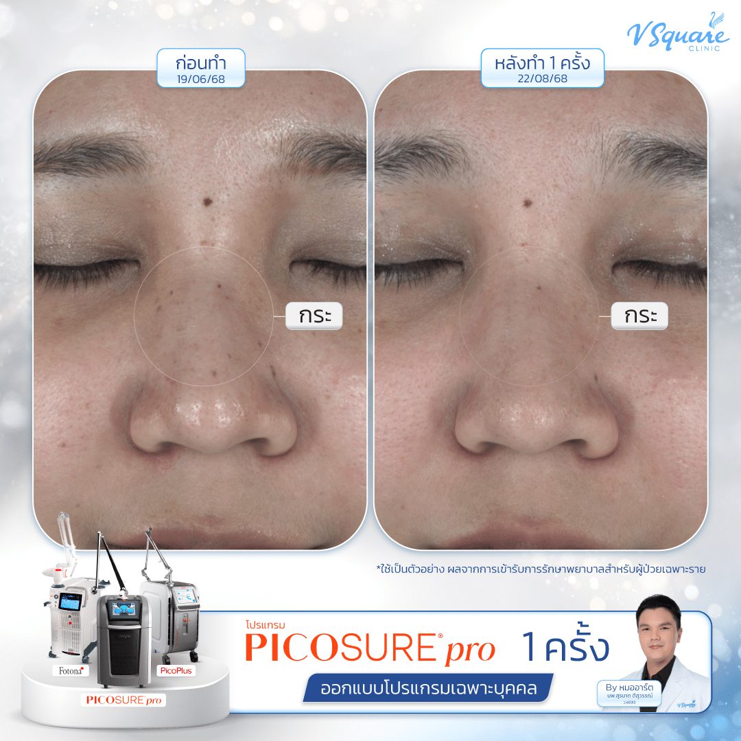 รีวิว Pico Laser รวมเคสเคลียร์ฝ้า กระ รอยสิว ดูผลลัพธ์หลังทำ